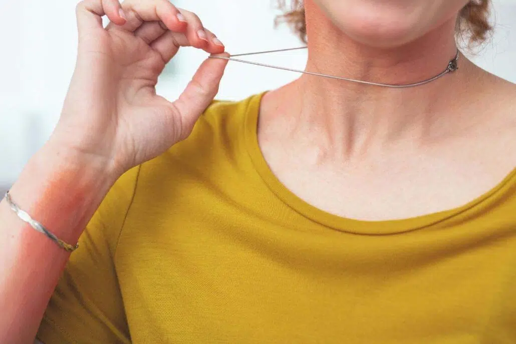 Skin Irritation by Metal Allergy from Jewelry | NJ & PA