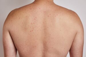 Stop the Scratching: Solutions to Manage Drug Allergy Rash