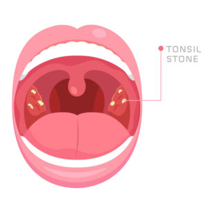 Tonsil and Adenoid Surgery | Becker ENT & Allergy NJ & PA